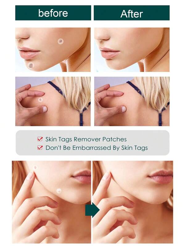 Skin Tag Remover Patch, 120pcs Round Skin Tag and Acne Removal Patches ...