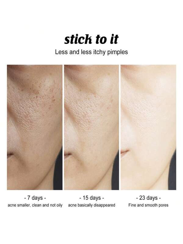 120g Africa Soap For Acne Prone Skin, Face, Body & Back Cleansing ...