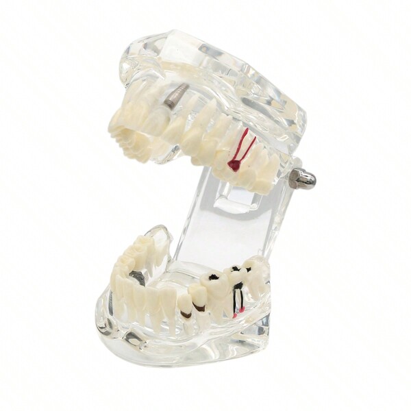 Comprehensive dental pathology model without missing teeth Crystal ...