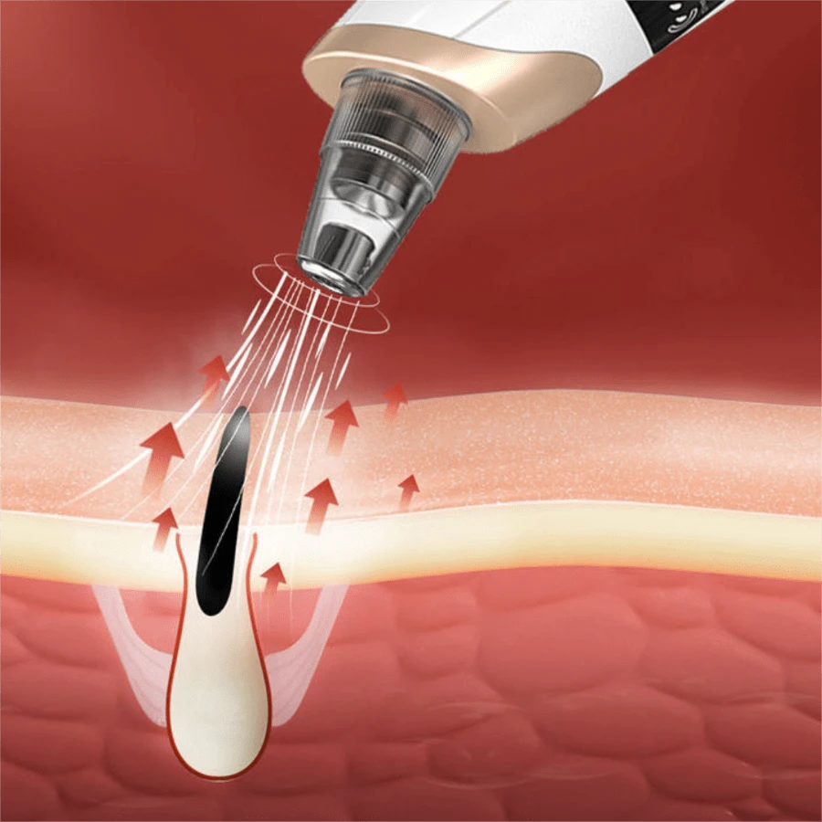 Electric Acne Spot Removal Device Microcrystalline Home Pore Cleaner ...