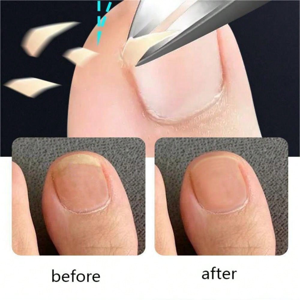 Stainless Steel Ingrown Toenail Tool Set With Eagle Beak Nail Clippers ...