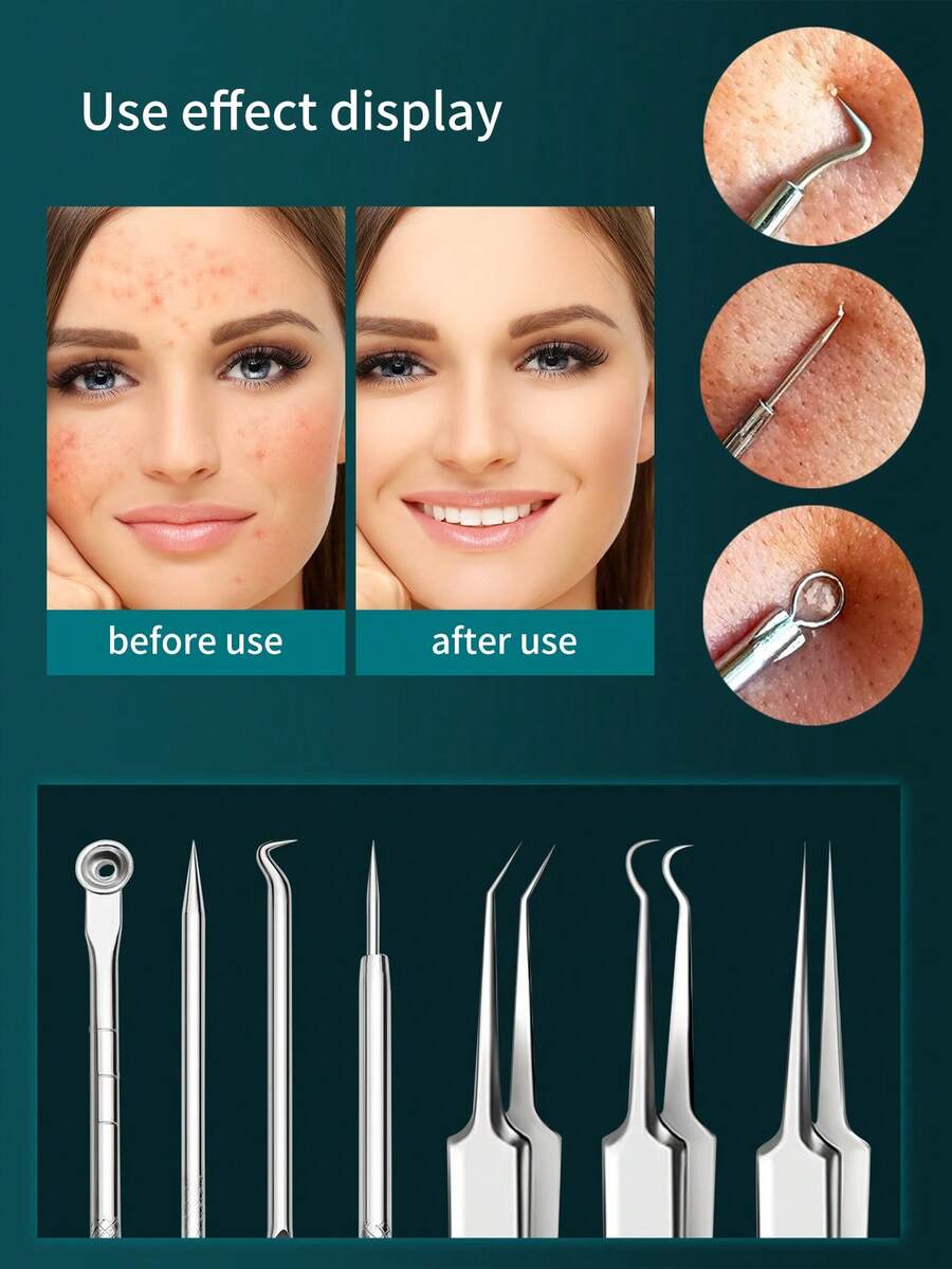Blackhead Popping Tool Kit, Facial Blackhead Extractor, Acne Extractor ...