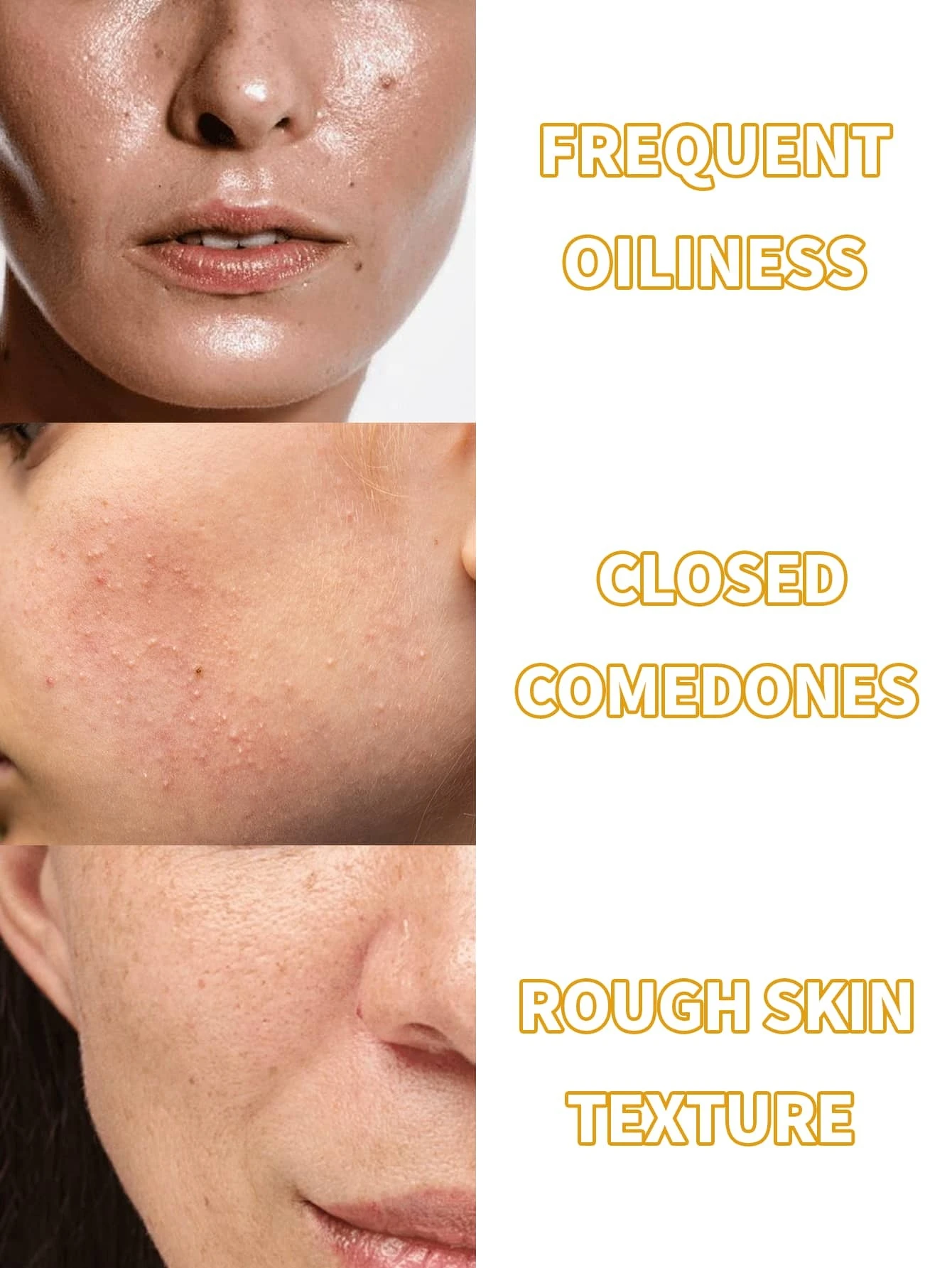 30g Salicylic Acid Facial Refinement Cream Moisturizer - Acne Treatment ...