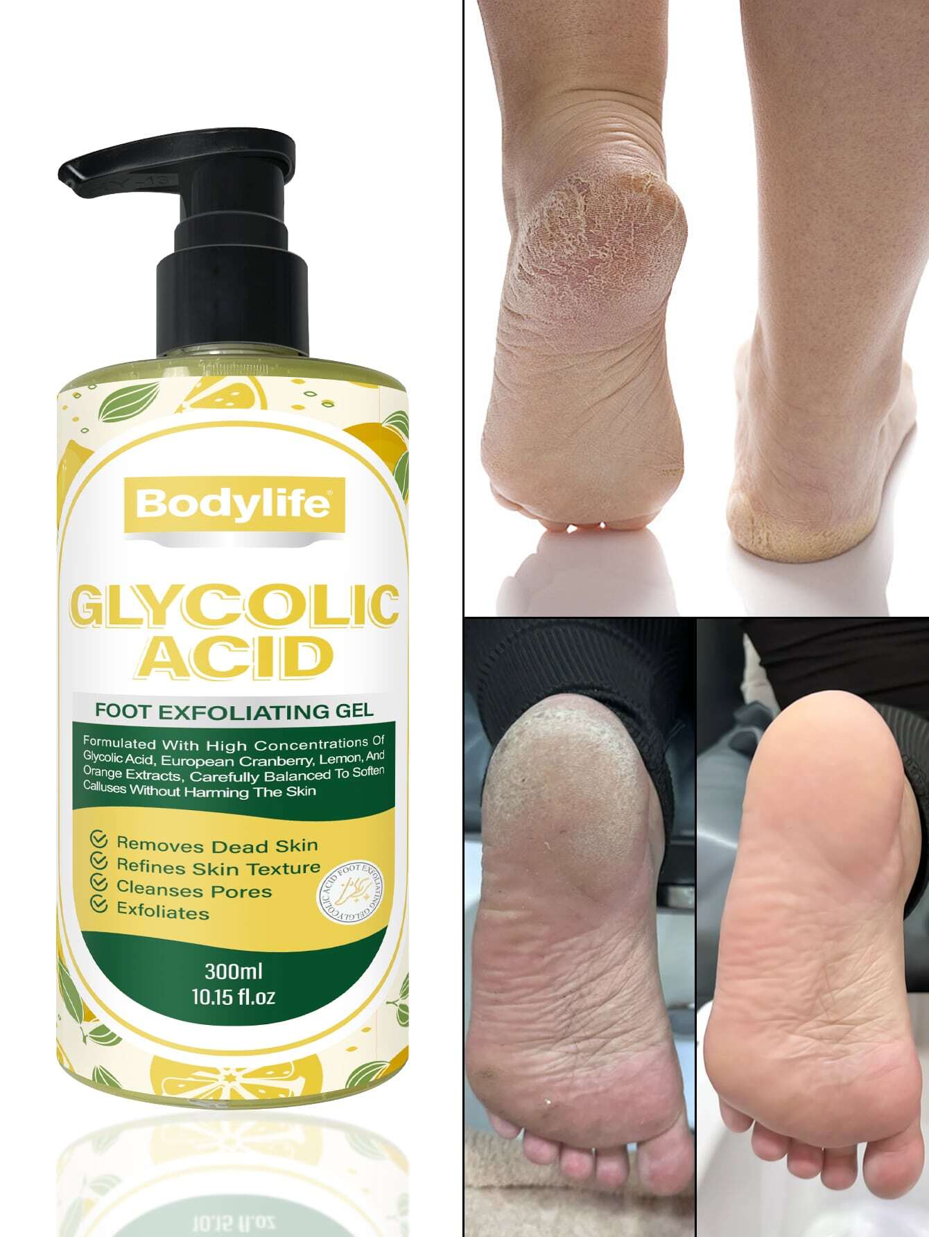 1 Bottle 300ml Foot Glycolic Acid Callus Softener,Foot Gel For Dry ...