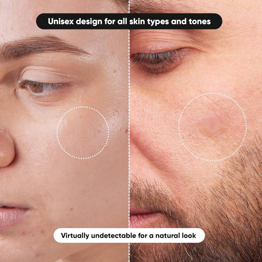 400 Patches Hydrocolloid Acne Patches, Blemishes Pimples Covering Patch ...