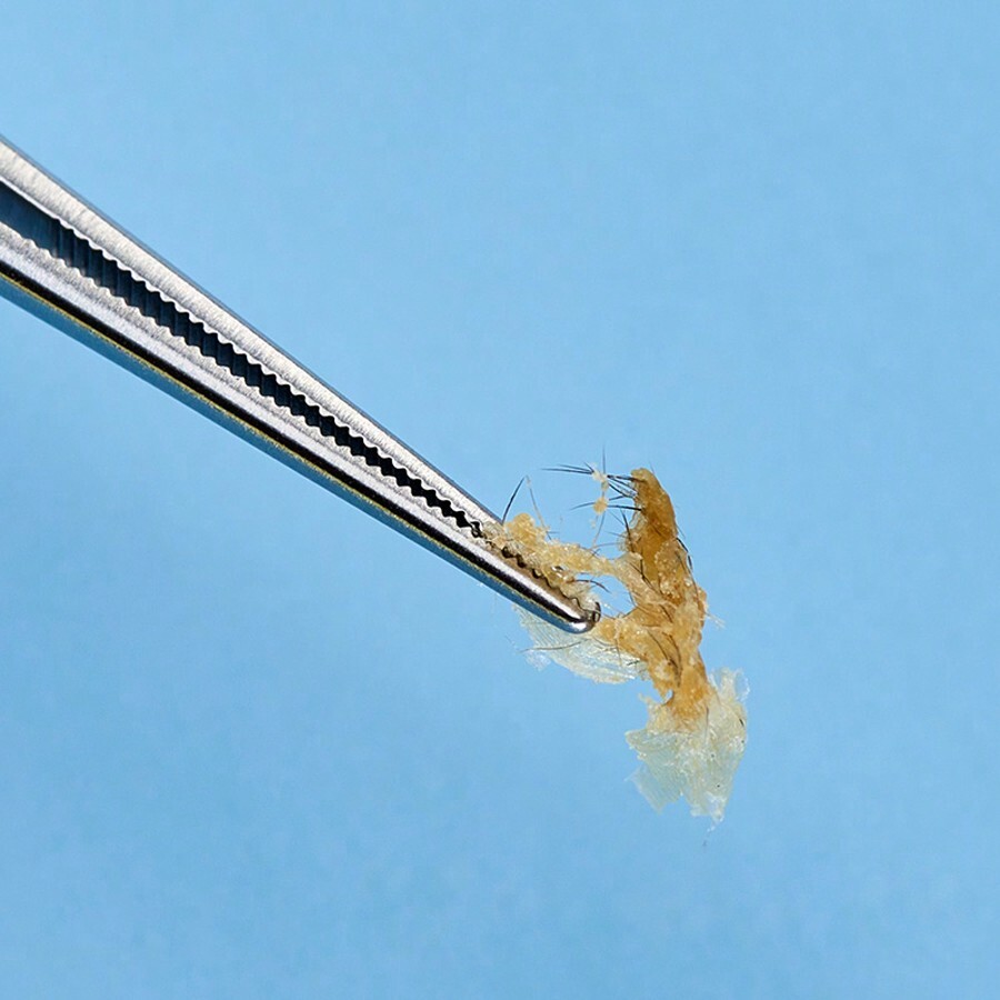 Curved Tip Stainless Steel Earpick Tweezersear Wax Removal Tool Ear Cleaner With Teeth Earwax