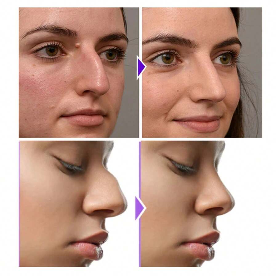 Nose Shaping Device With A Tight And Straight Contour, High Mountain ...