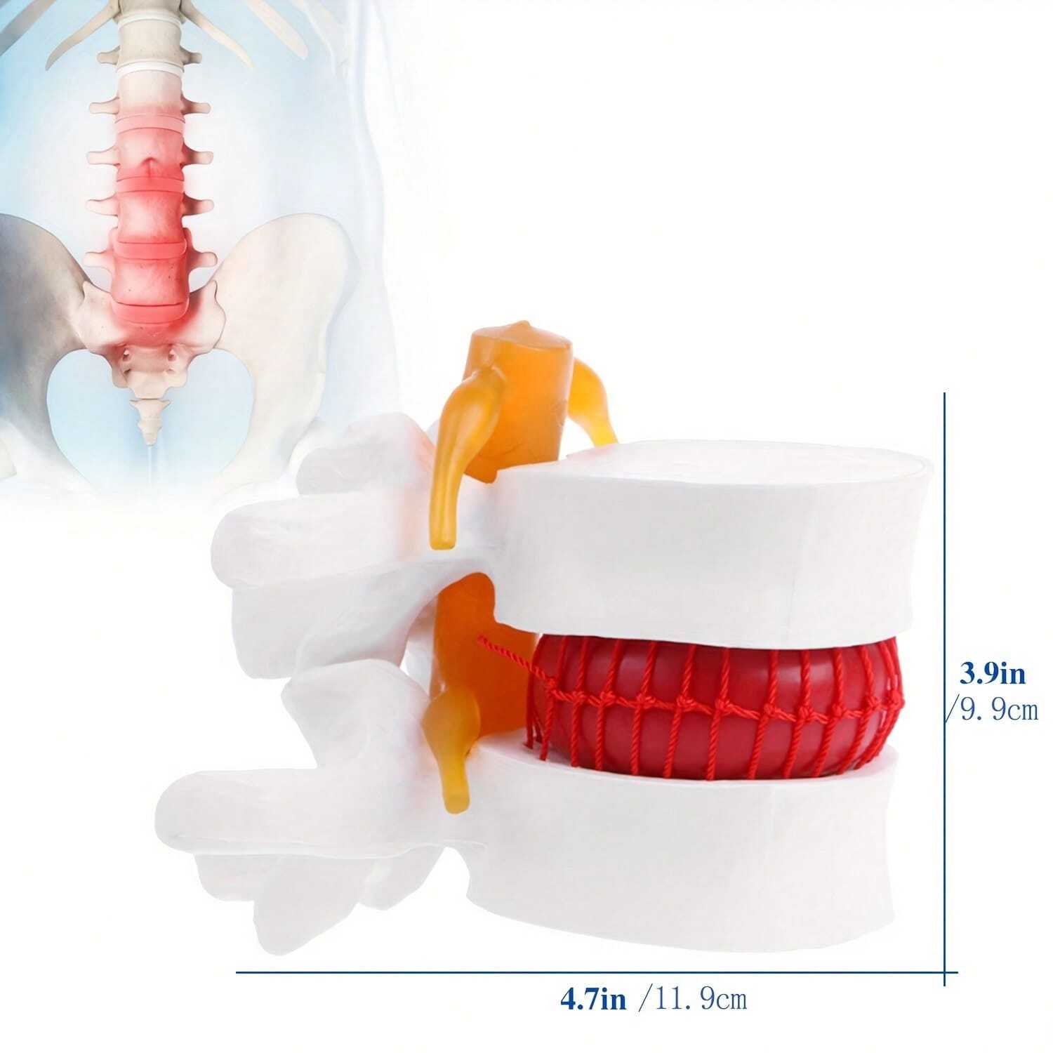 Human Anatomical Lumbar Disc Herniation Model - Lumbar Spine Model For ...