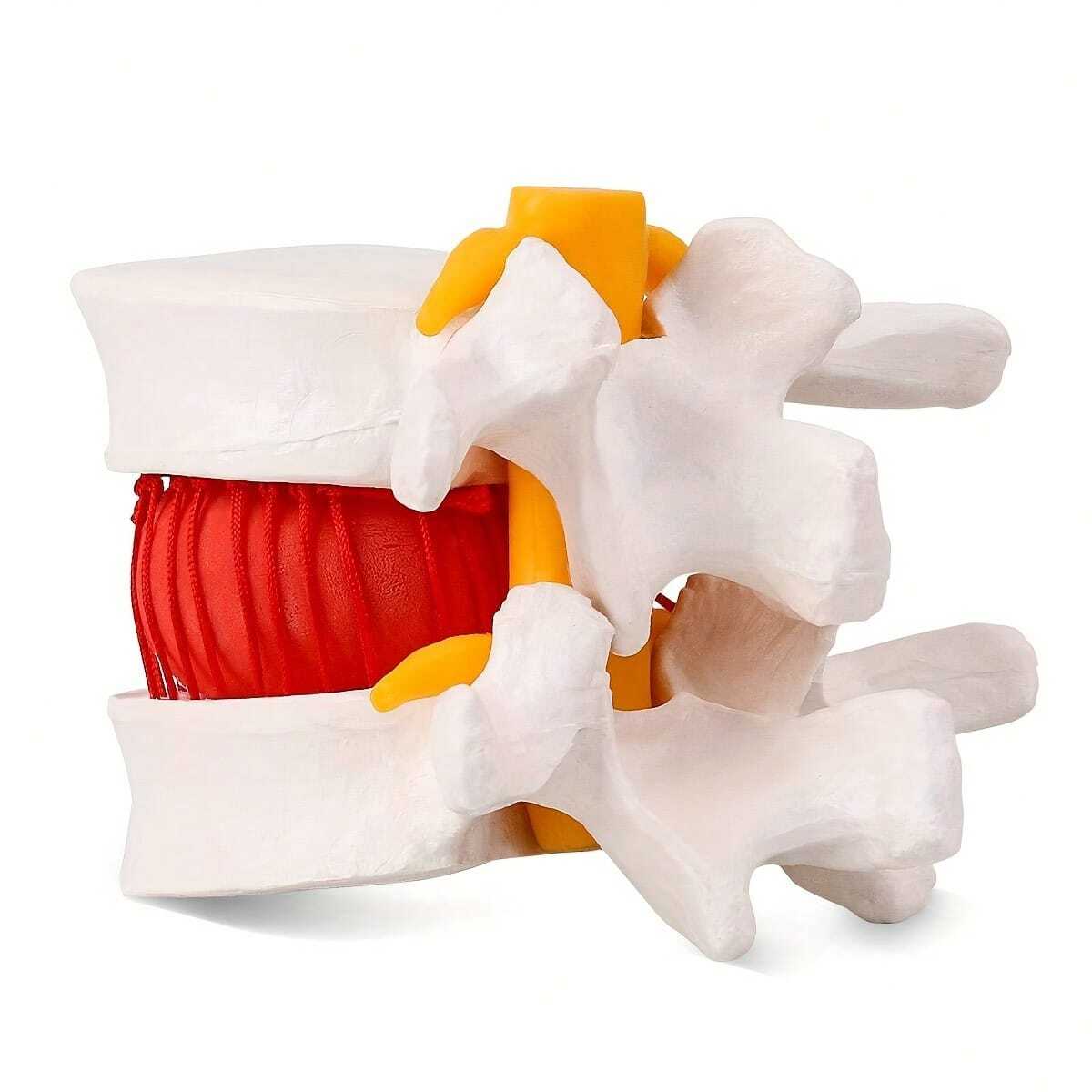 Human Anatomical Lumbar Disc Herniation Model - Lumbar Spine Model For ...