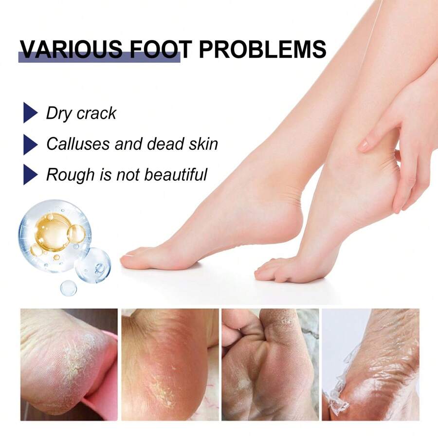 Ximonth Cracked Heel Ointment Repair Heel Calluses And Foot ...