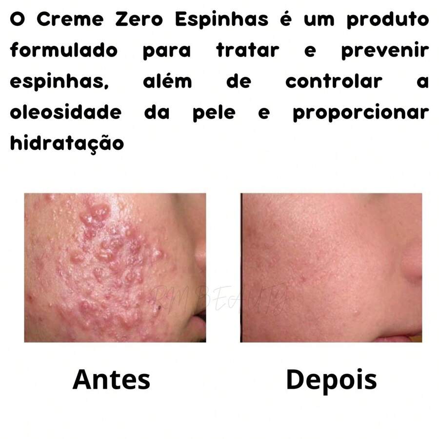 Creme Facial Zero Espinha Tratamento Contra Acne A pronta Entrega ...