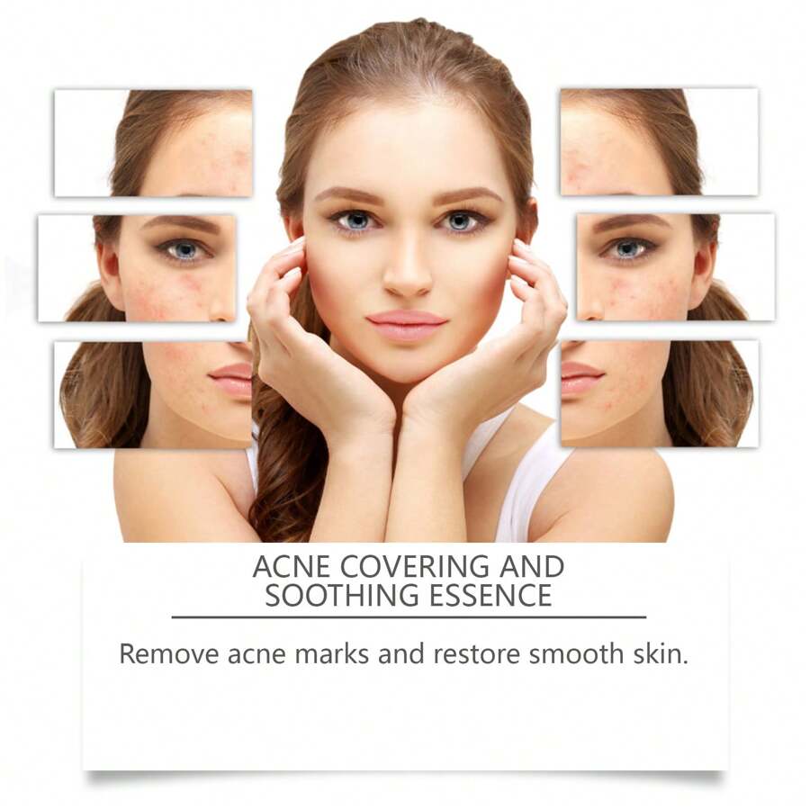 Hoygi Acne Soothing Serum Facial Skin Hydrating And Moisturizing Pitted ...