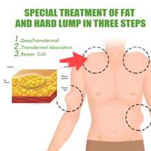 Fat Knot Cream Unblocks Various Fat Clumps And Subcutaneous Lumps Body ...