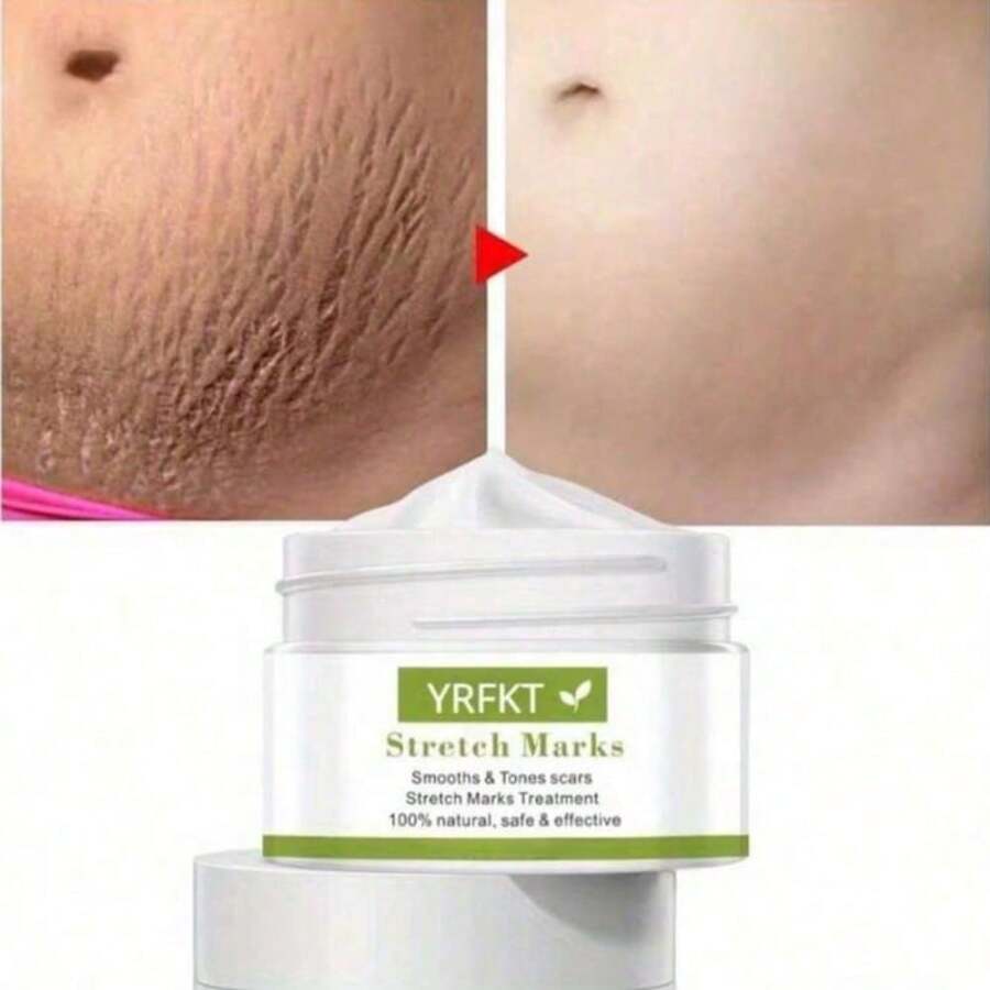 Di adiós a las estrías con nuestra poderosa crema desvanecedora ...