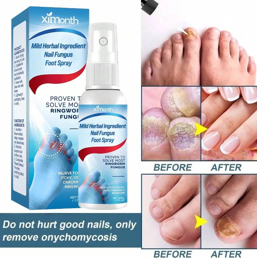 Toe Nail Fungus Treatment Spray Deep Cleansing Feet Skin Itching Relief ...