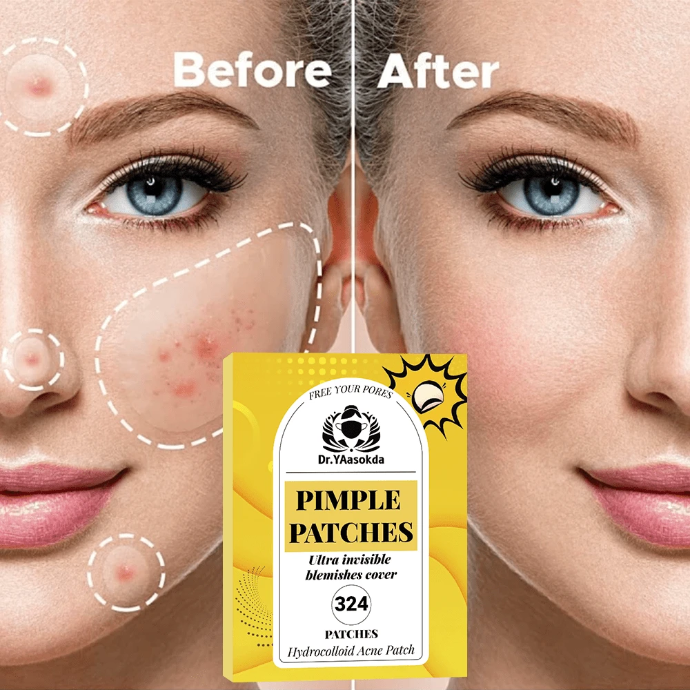 Hydrocolloid Acne Patches – Invisible Pimple Patch For Spot Treatment ...